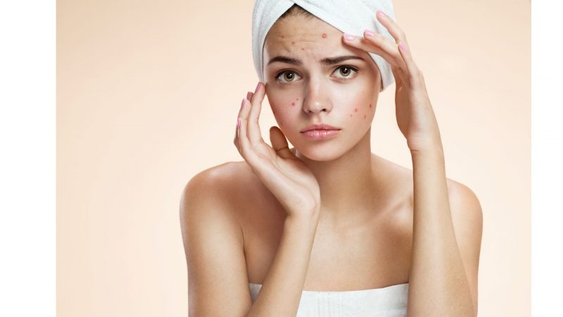 How to get rid of pimples